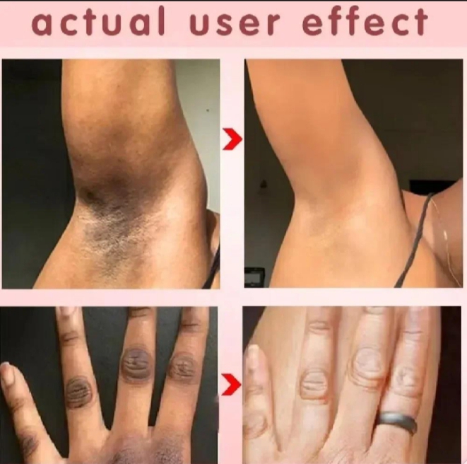 Original Whitening Cream for sensitive Areas underarm and private Areas ...